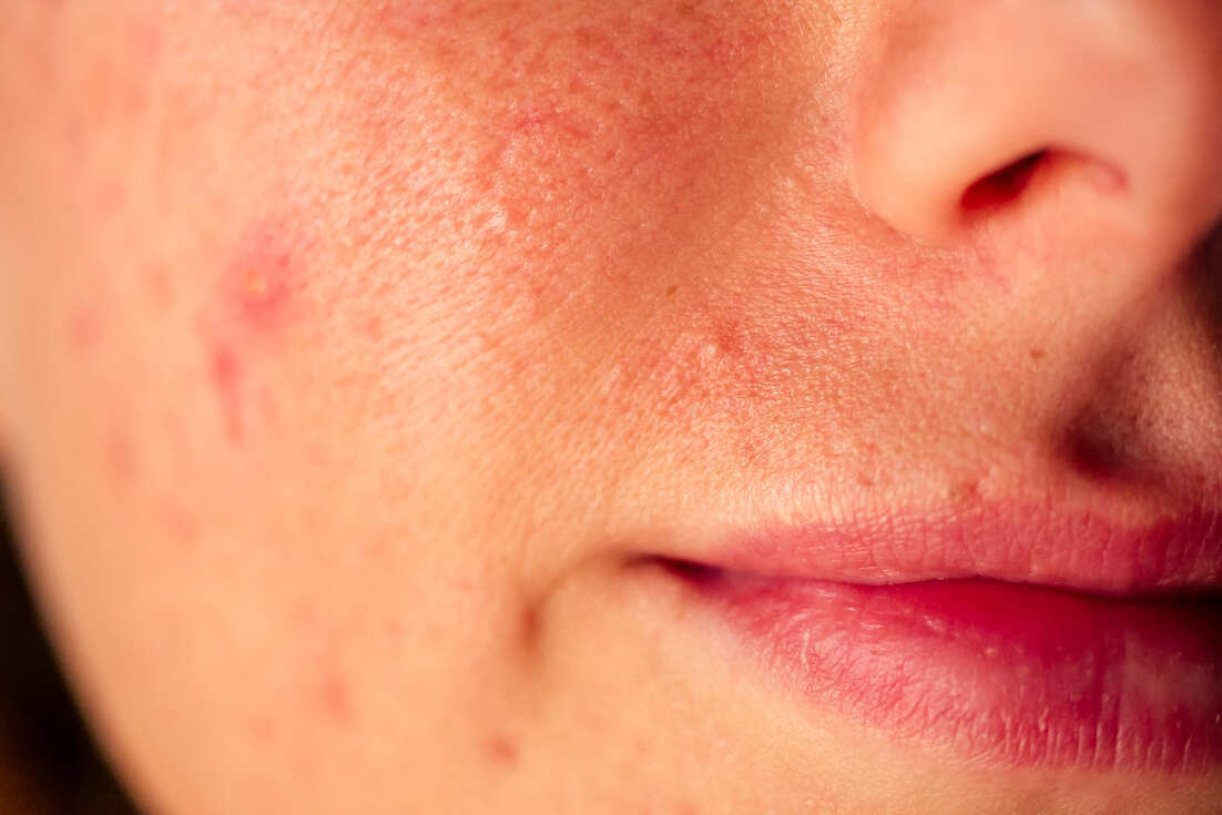 How Gut-Brain Health Affects Skin and Acne
